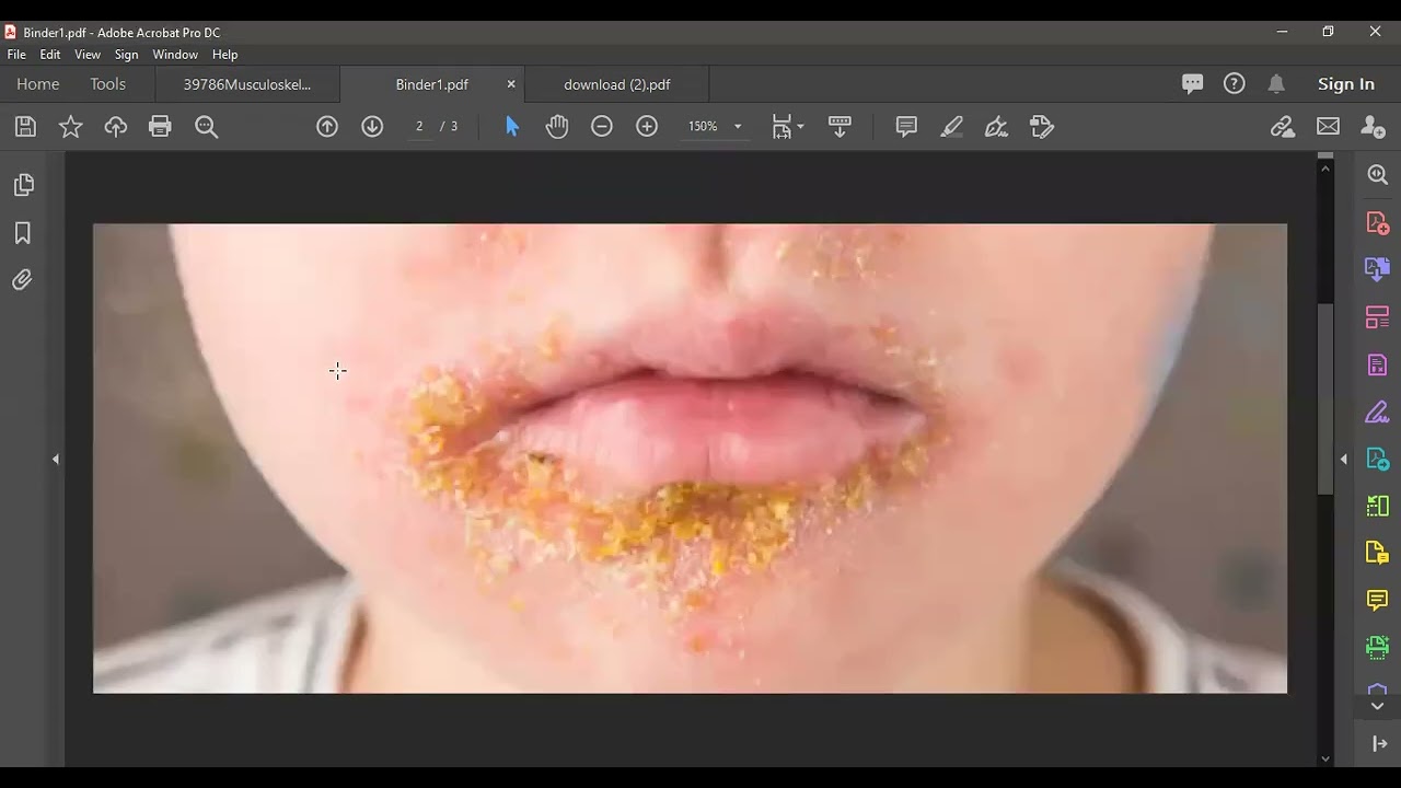 L18 MICRO :Staphylococcus and streptococcus infections - YouTube