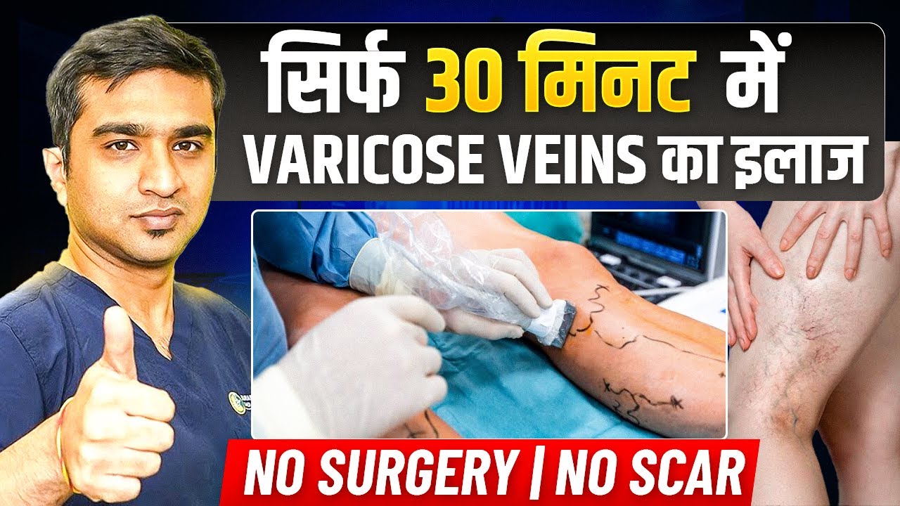 Varicose Veins Treatment Without Surgery | 30 Minutes Procedure | Dr ...