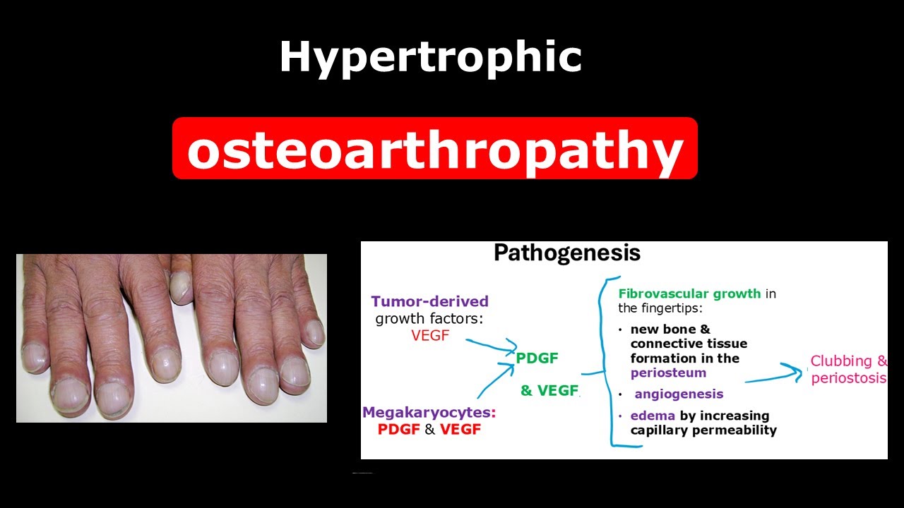 Hypertrophic osteoarthropathy for USMLE (Digital clubbing ...