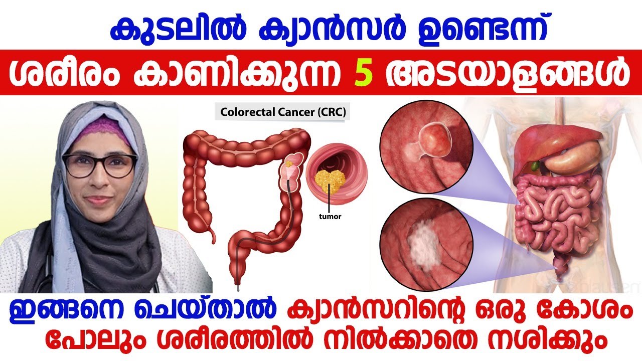 കുടൽ കാൻസർ ഉണ്ടെന്ന് ശരീരം കാണിക്കുന്ന 5 അടയാളങ്ങൾ|kudal cancer ...