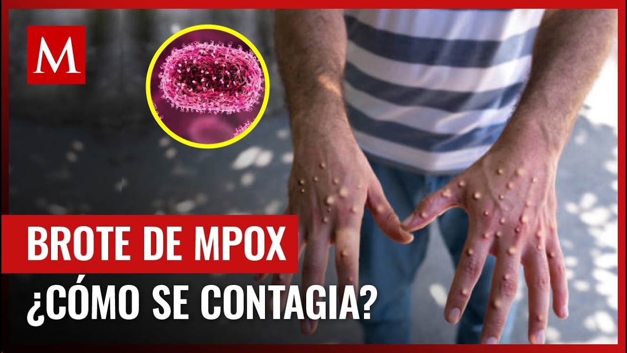 ¿Qué es el Mpox y cómo se contagia? La Organización Mundial de la Salud ...