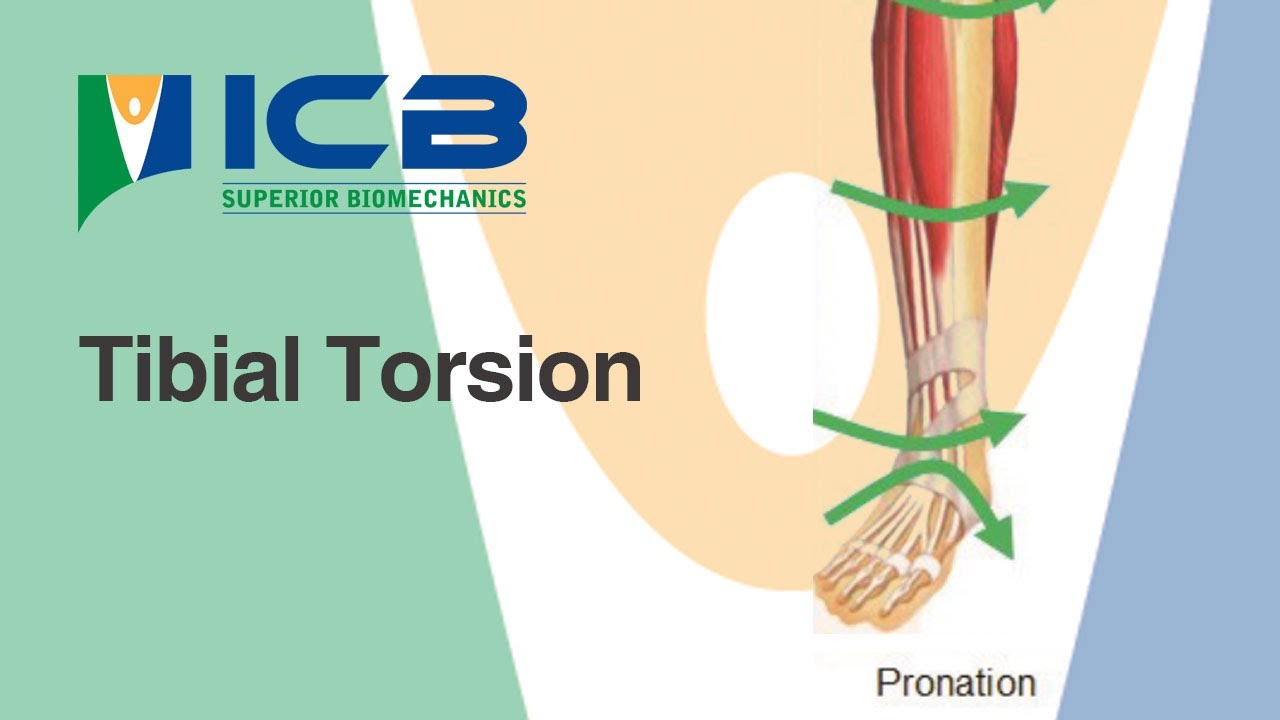Tibial Torsion Gait Plates - YouTube