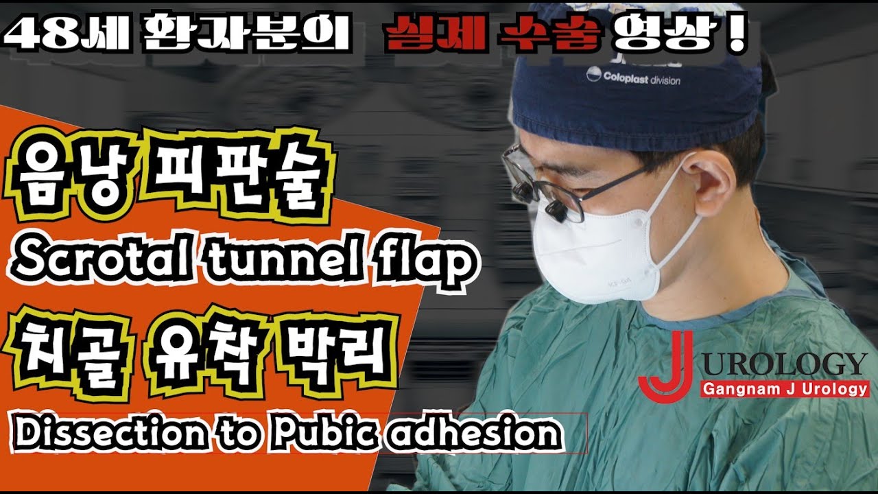음낭 피판술 scrotal tunnel flap & 치골유착박리 Dissection to Pubic adhesion ...