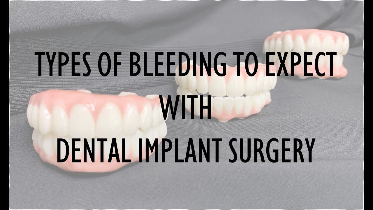 Types of Bleeding to Expect with Dental Implant Surgery | Full Mouth ...
