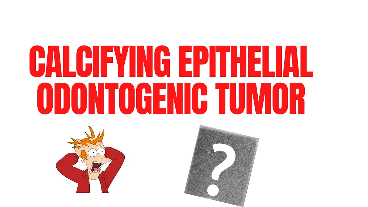 CALCIFYING EPITHELIAL ODONTOGENIC TUMOR - PART1 - PINDBORG TUMOR I CEOT ...
