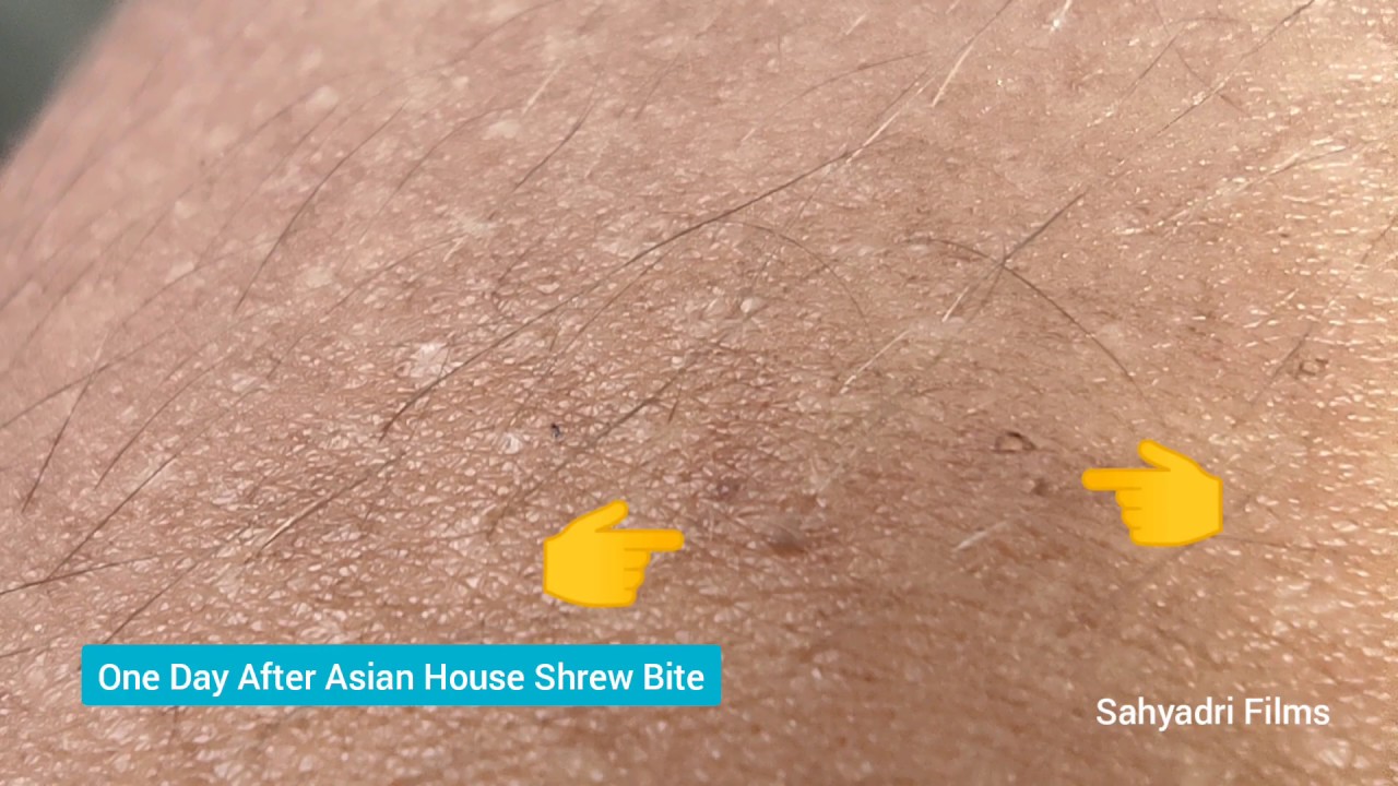 Asian House Shrew Bite Sign To Human | Shrew bites sign or symptoms ...