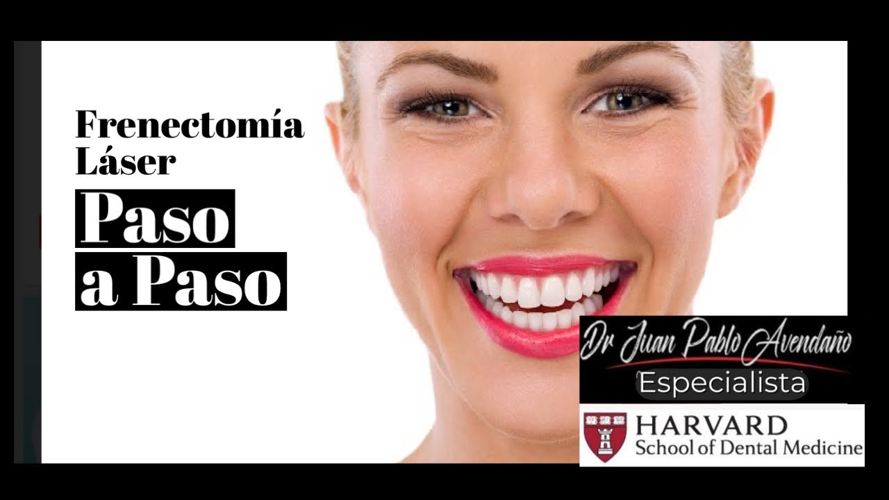 ¿Como se hace la Frenectomía a láser Paso a Paso En Vivo?. Sin sutura # ...