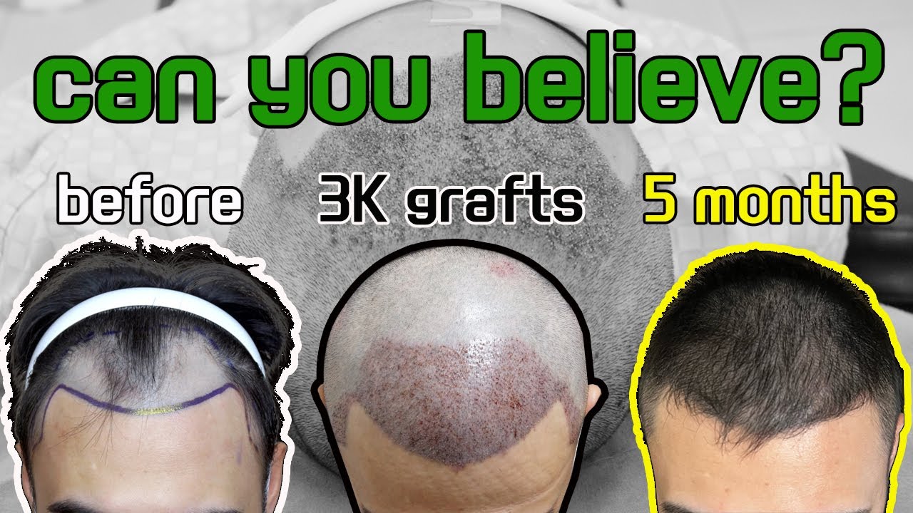 5 MONTHS FUE Update at Motion Clinic, South Korea 3K Grafts You Won’t ...