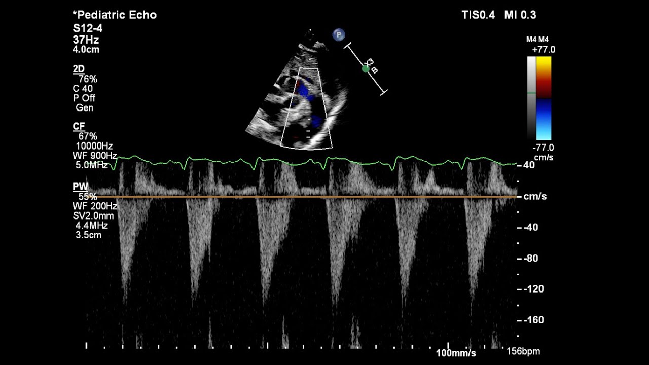 Basic echocardiography(심장 초음파 기본)- RDS 치료 전후의 PDA의 영상과 의미 - YouTube