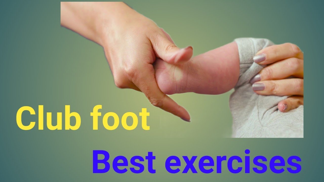 Club foot Best exercise(C.T.E.V) physio near me flat fit exercise ...