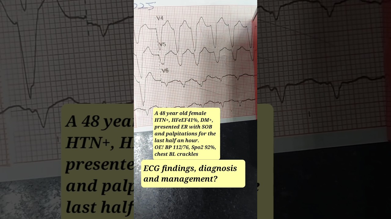 Ecg quiz 7! Ecg findings, diagnosis, and management? #ecg - Go IT