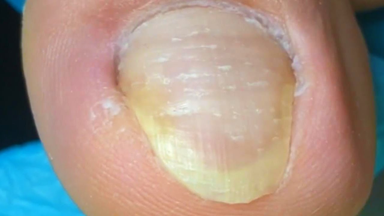 Seemingly ordinary toenails tear out huge dead skin #Pedicure - YouTube