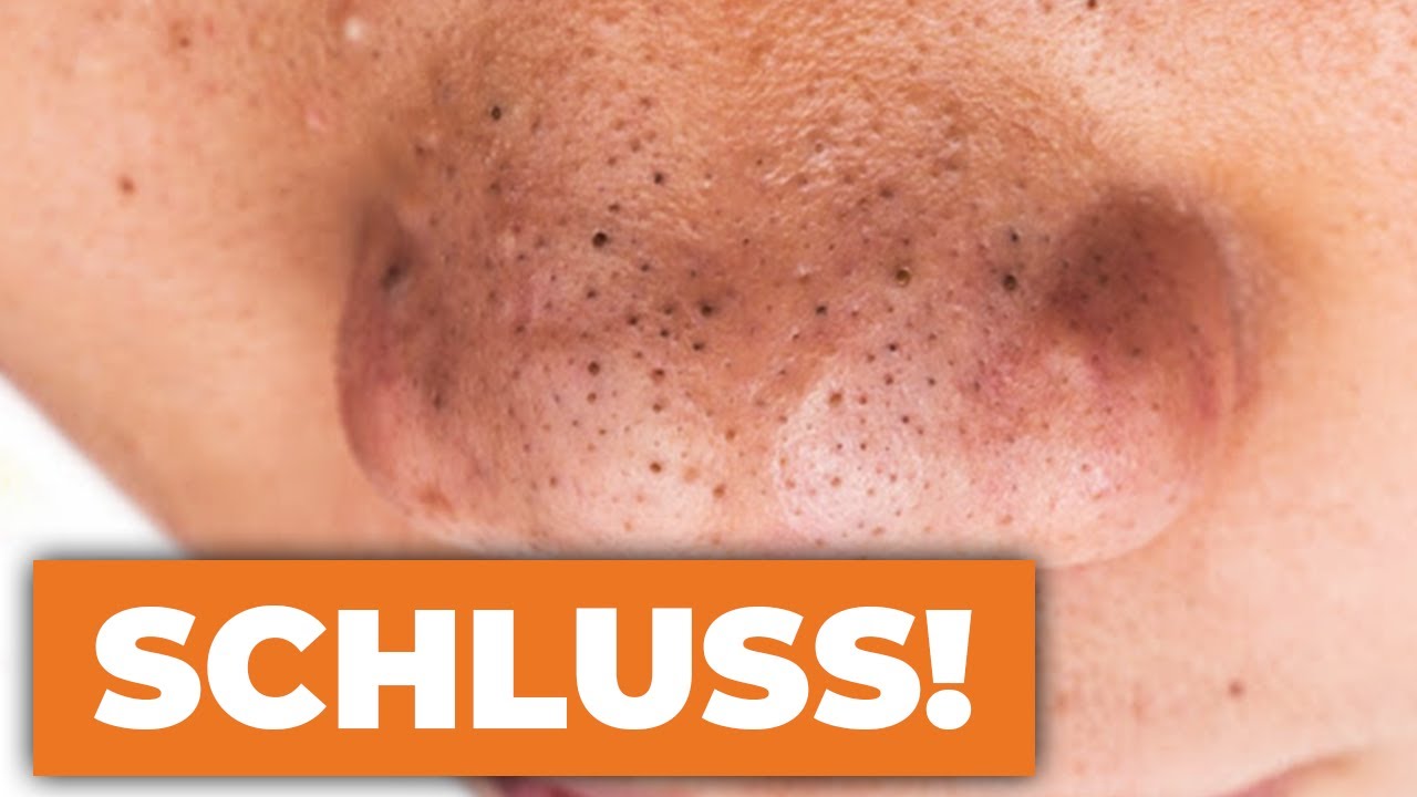 3 Hausmittel um Mitesser zu bekämpfen! - YouTube