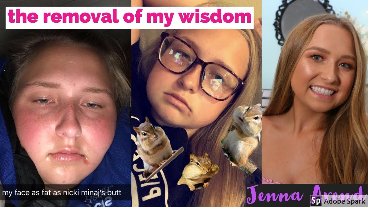 I GOT MY WISDOM TEETH OUT! | Jenna Arend ♡ - YouTube