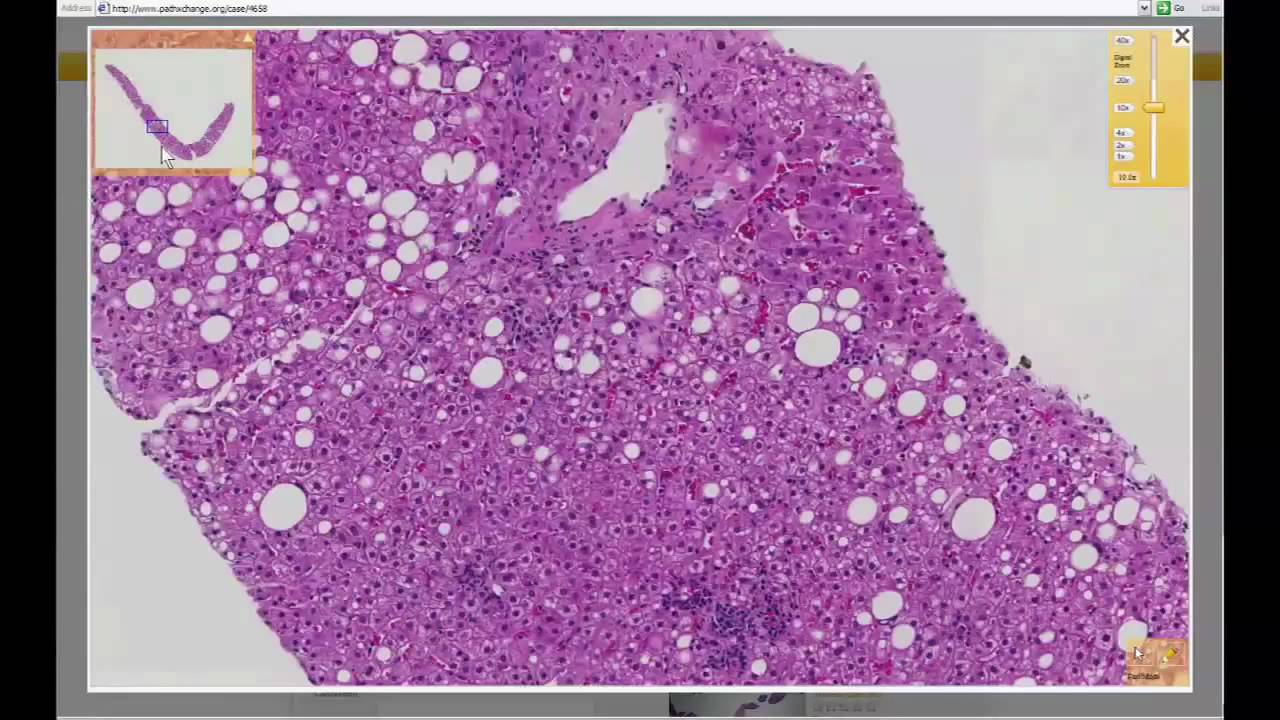 Approach to Liver Biopsy with Keith Kaplan, MD - YouTube