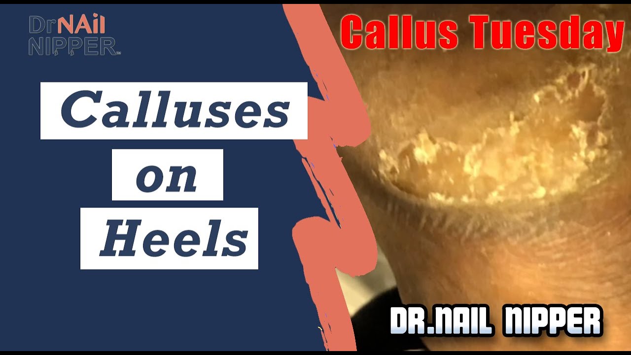 Calluses on Heels [Callus Tuesday] (2020) - YouTube
