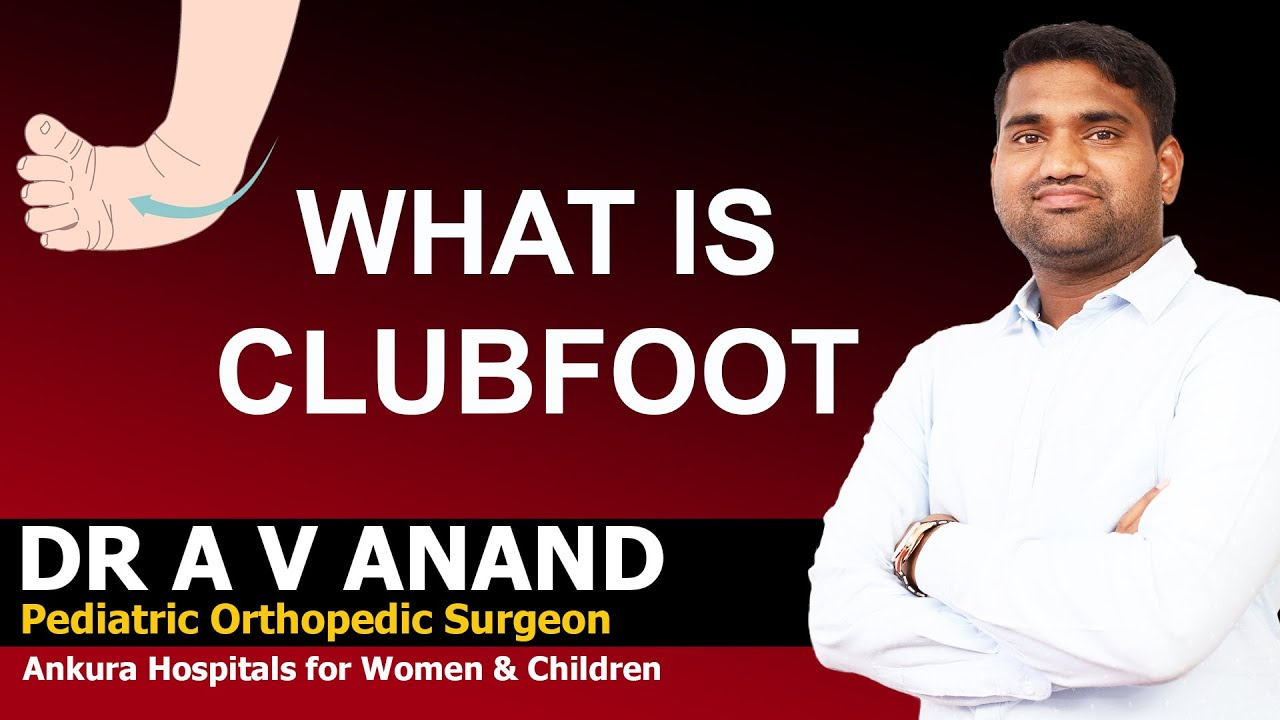 What is Club Foot & Types of Club Foot | Dr.AV Anand Pediatric ...
