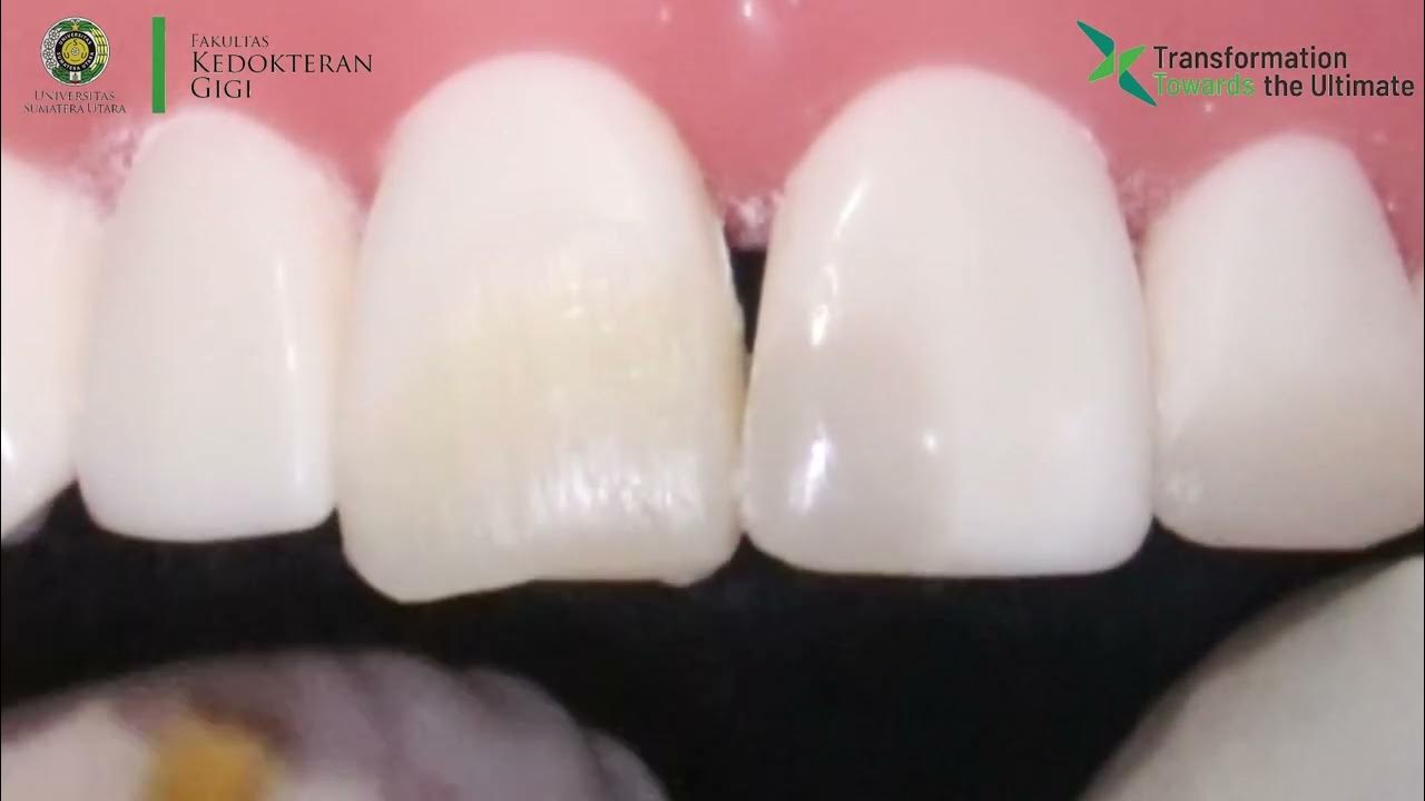 Restorasi Direk Resin Komposit Klas IV dengan Teknik Free Hand - YouTube