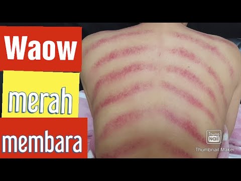 KEROKAN SAMPAI MERAH /kembung perut sembuh - YouTube
