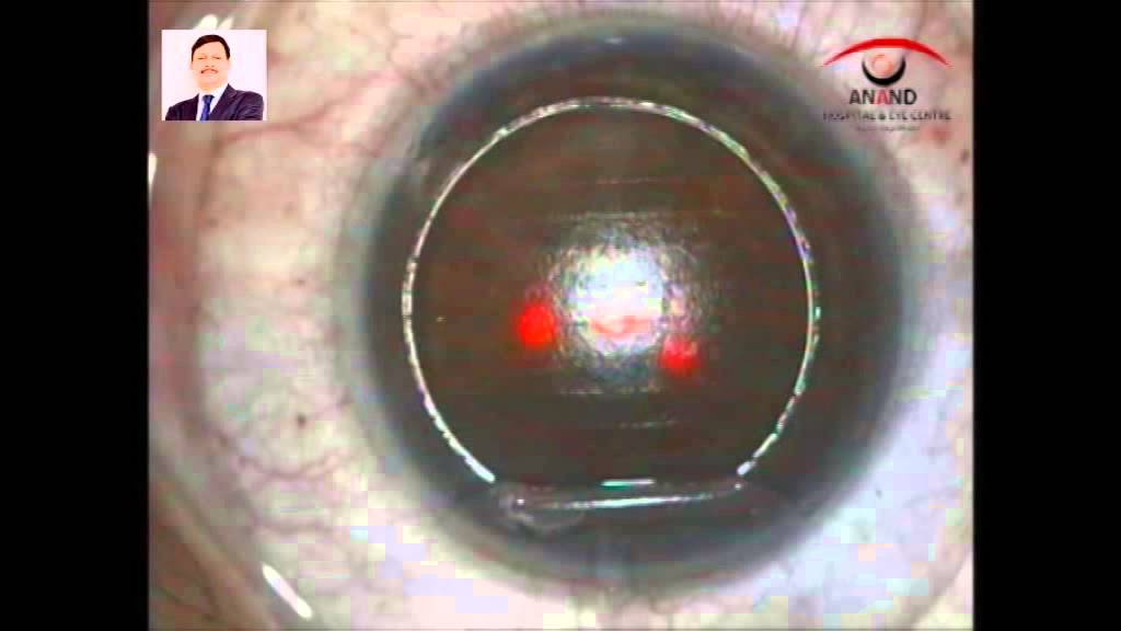 FEMTO FLAP DR.SONU GOEL - YouTube