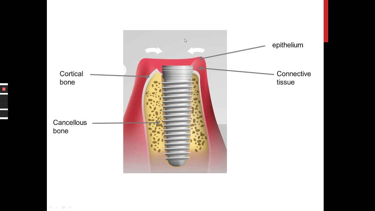Classification of implants - YouTube