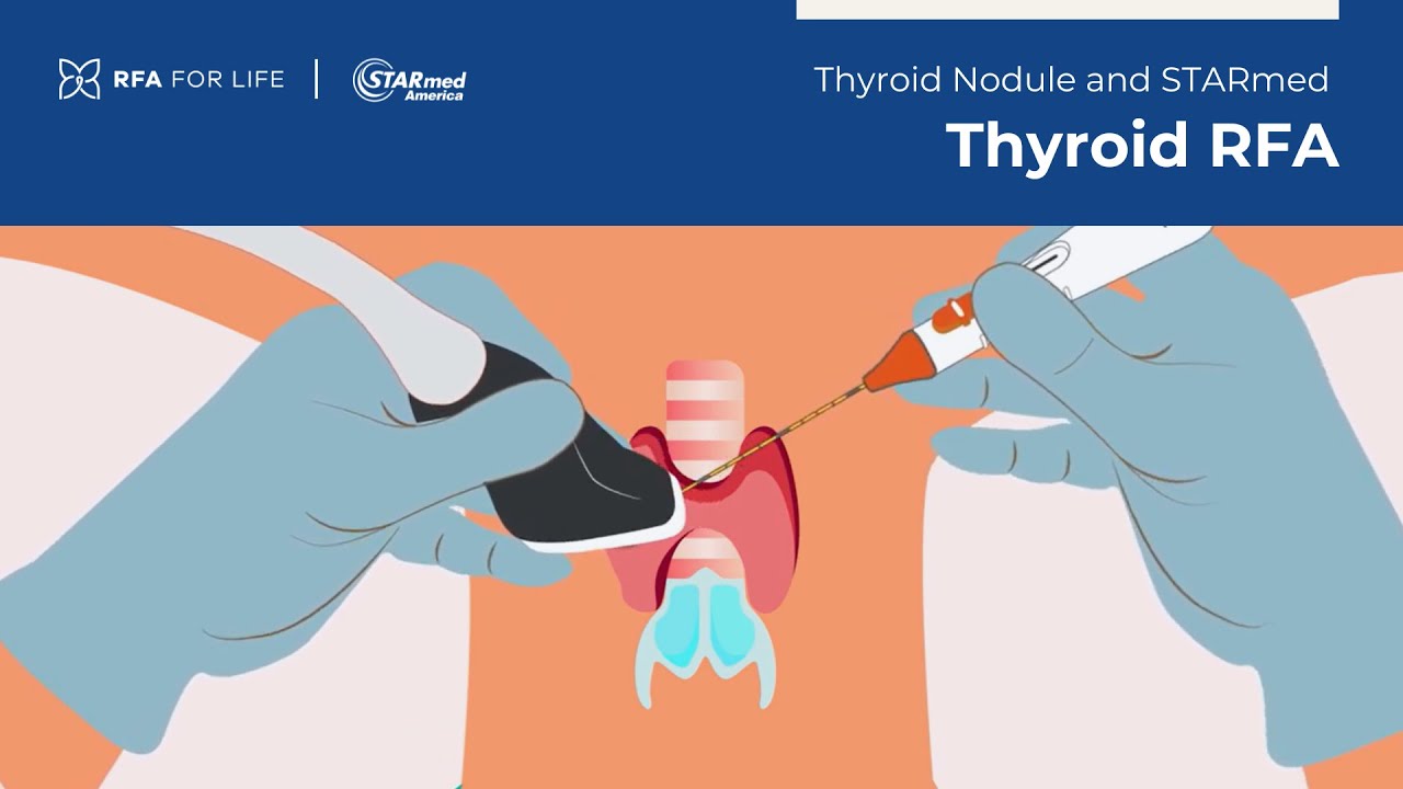 Thyroid Nodule and STARmed Thyroid RFA - YouTube