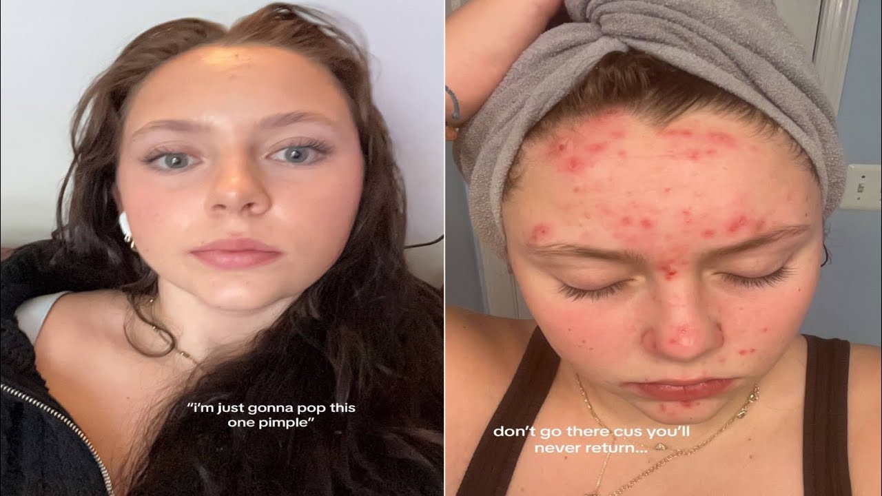 Popping Giant Pimple & Popping Huge Blackheads - Best Pimple Popping ...