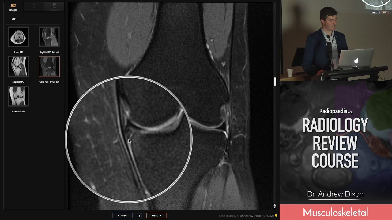 Horizontal Meniscal Tears (MRI) - Radiology Review Course - YouTube