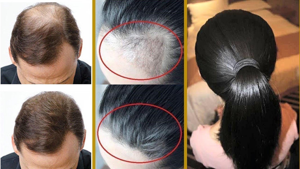 Tratamiento Milagroso de 7 días para Gente Calva | Aplicar en Cabello y ...
