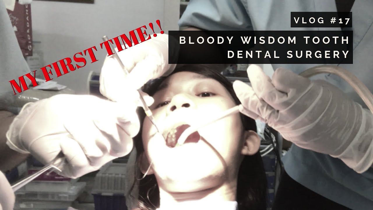 A BLOODY Wisdom Tooth Dental Surgery - YouTube