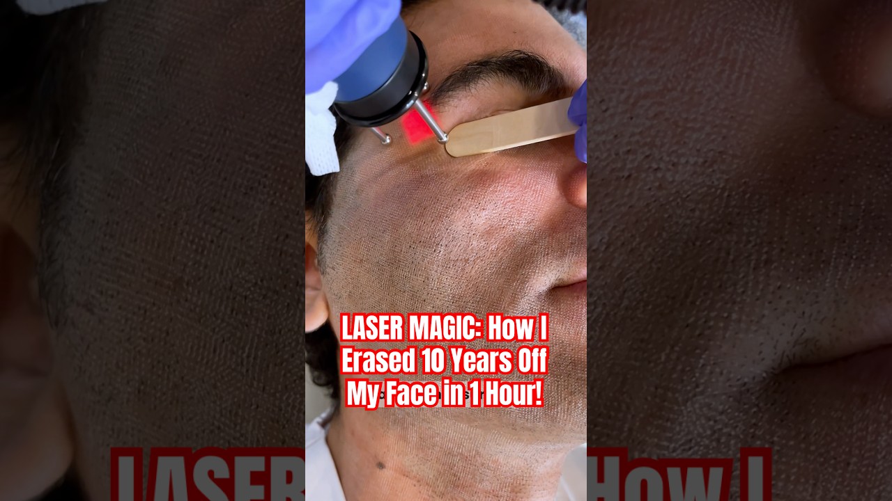 LASER MAGIC: How I Erased 10 Years Off My Face in 1 Hour! - YouTube