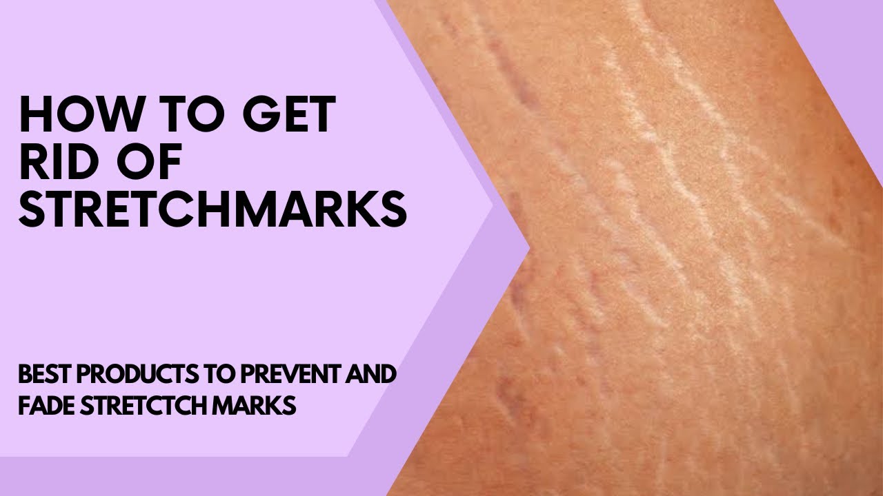 How I got rid of my stretch marks || Effective products to fade and ...