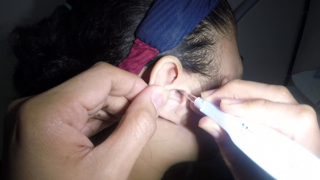 3 Girl's with Different Kinds of Earwax Removal - YouTube