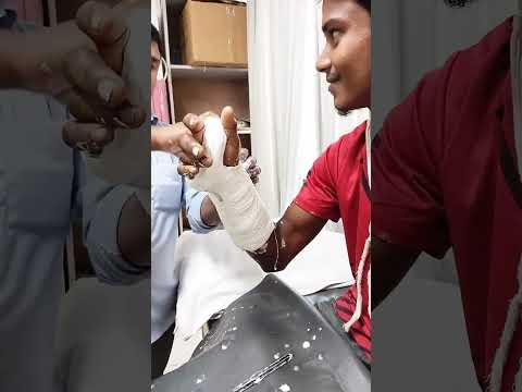 colles Fracture plaster Video - YouTube
