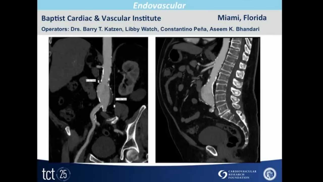 Demonstration: Magellan Live Patient Case at TCT 2013- Hansen Medical ...