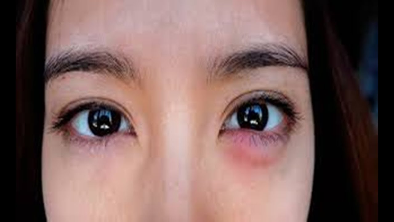 Olhos inchados: quais as causas e tratamento? - YouTube
