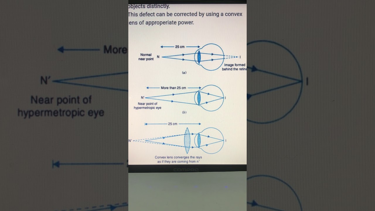 Hypermetropia class 10 - YouTube