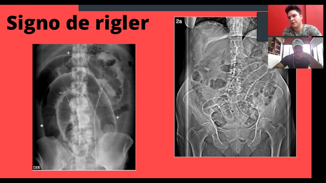 Neumoperitoneo- Laboratorio Imagenología agosto-octubre 2021 - YouTube