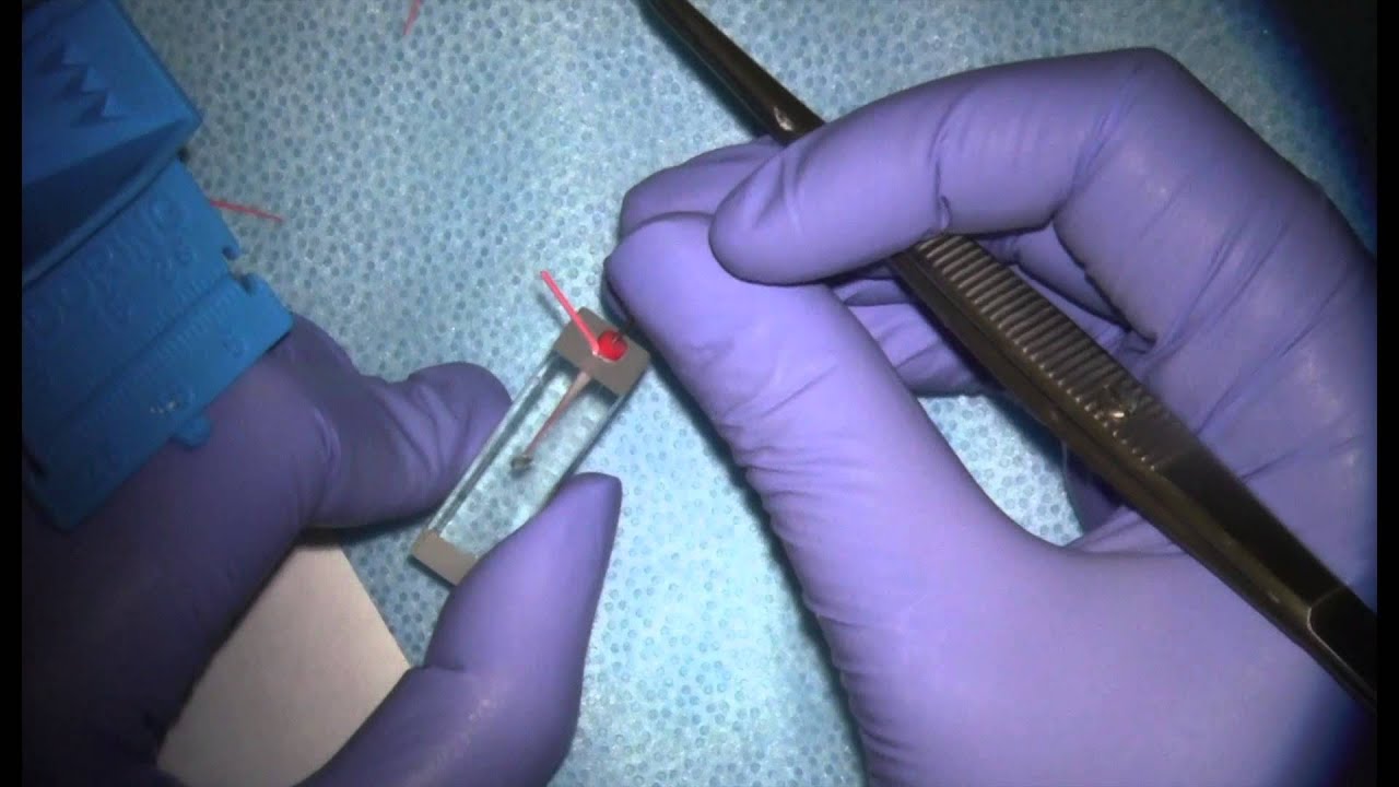 Cold Lateral Obturation - YouTube