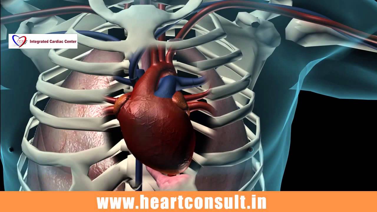 Coronary Artery Disease Treatment | Cardiac Angiogram - YouTube
