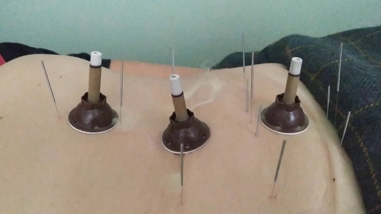 IBS Abdominal Acupuncture Treatment - YouTube