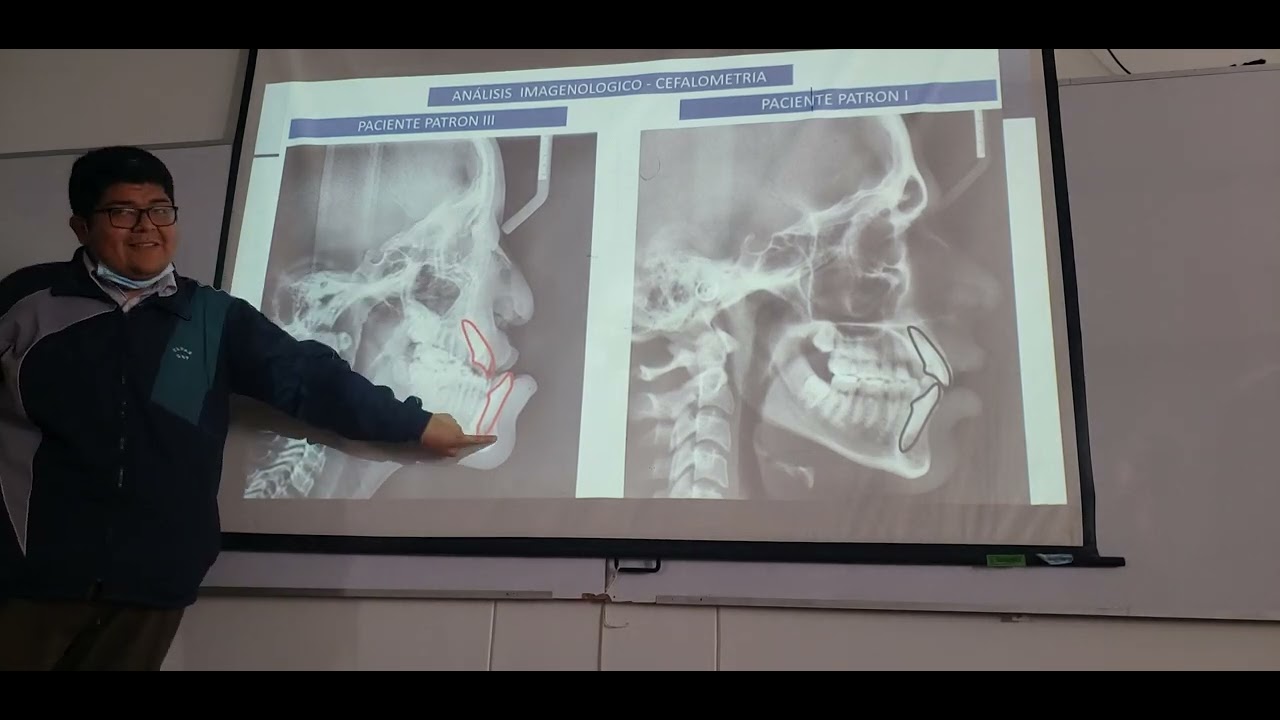 colapso anterior de mordida segunda parte - YouTube