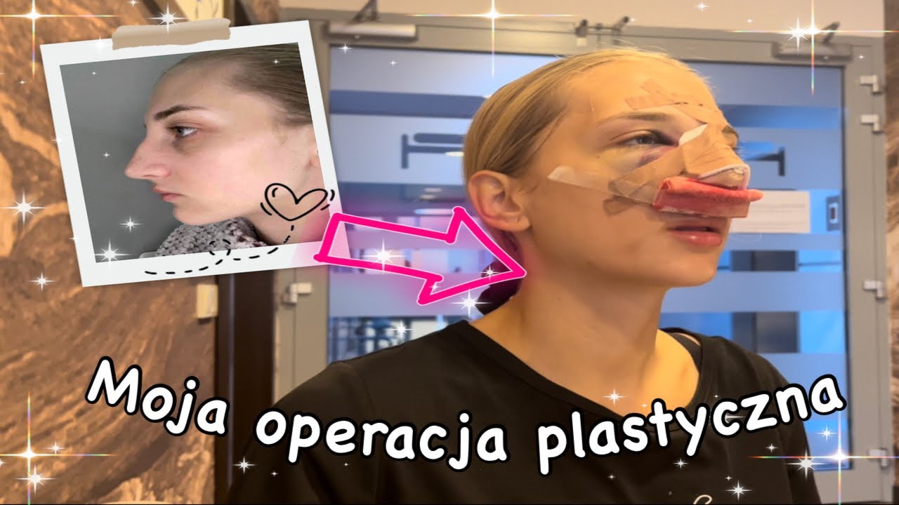 MOJA OPERACJA PLASTYCZNA NOSA - YouTube
