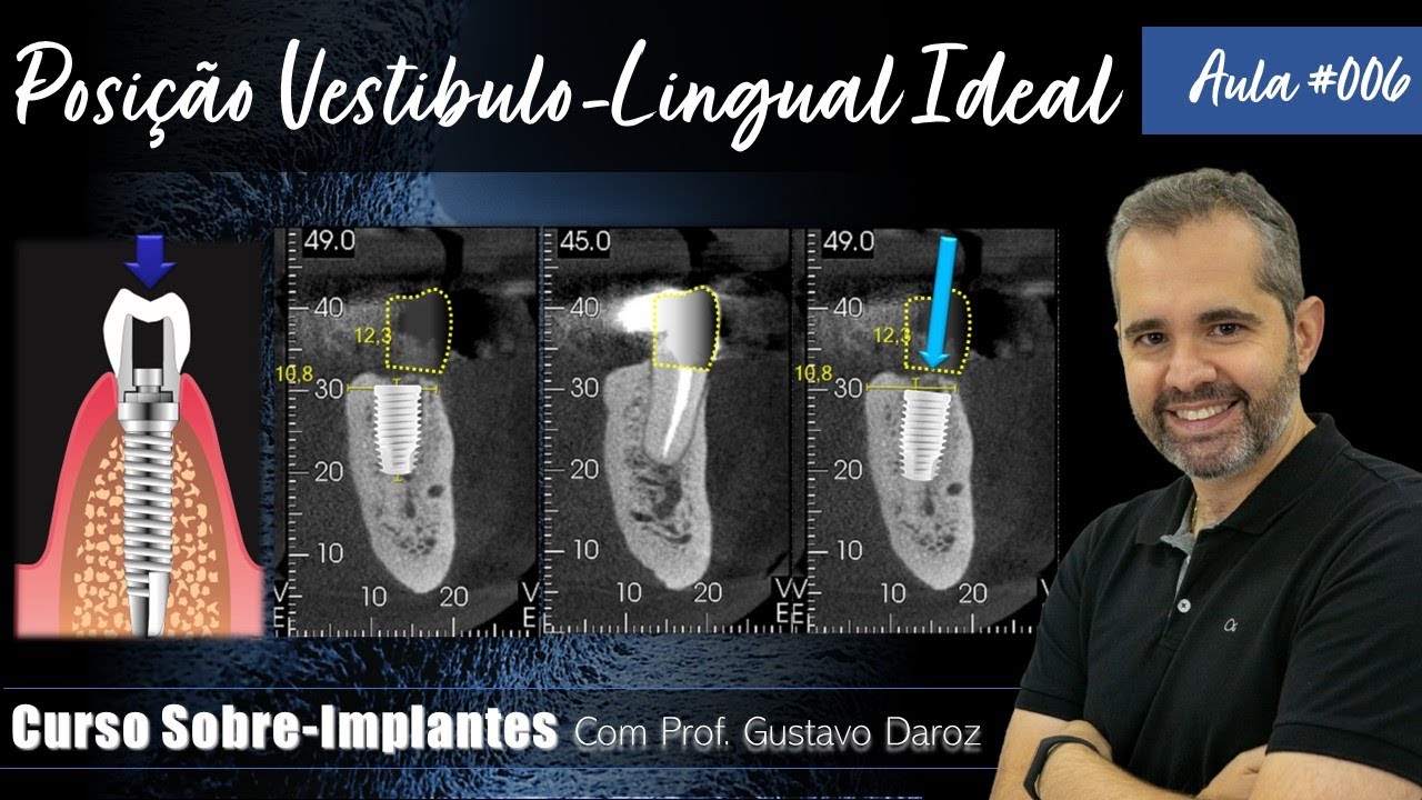 Posição VESTÍBULO-LINGUAL ideal do Implante - Curso SOBRE-IMPLANTES ...