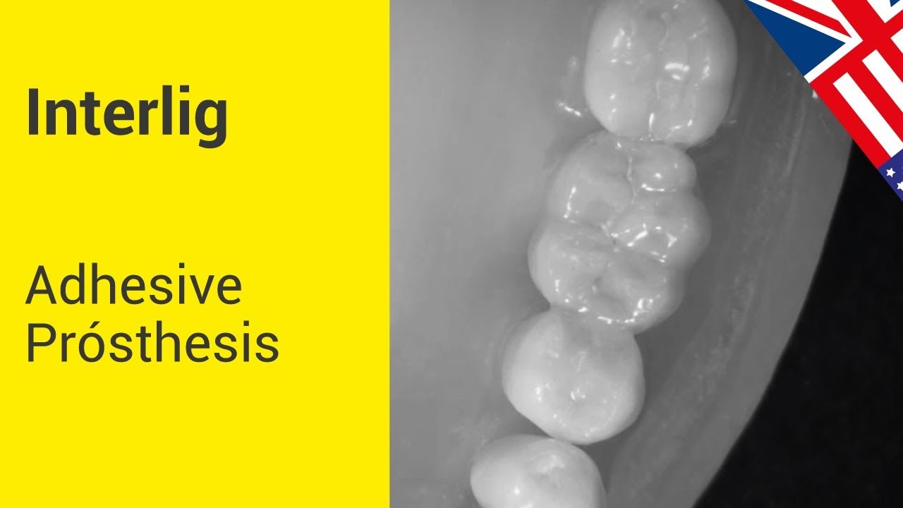 INTERLIG - Adhesive Prosthesis - YouTube