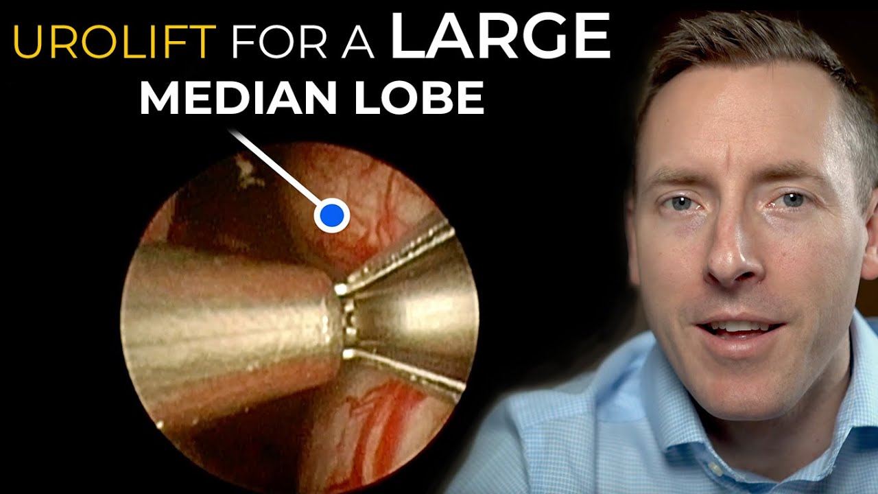 Median Lobe Prostate