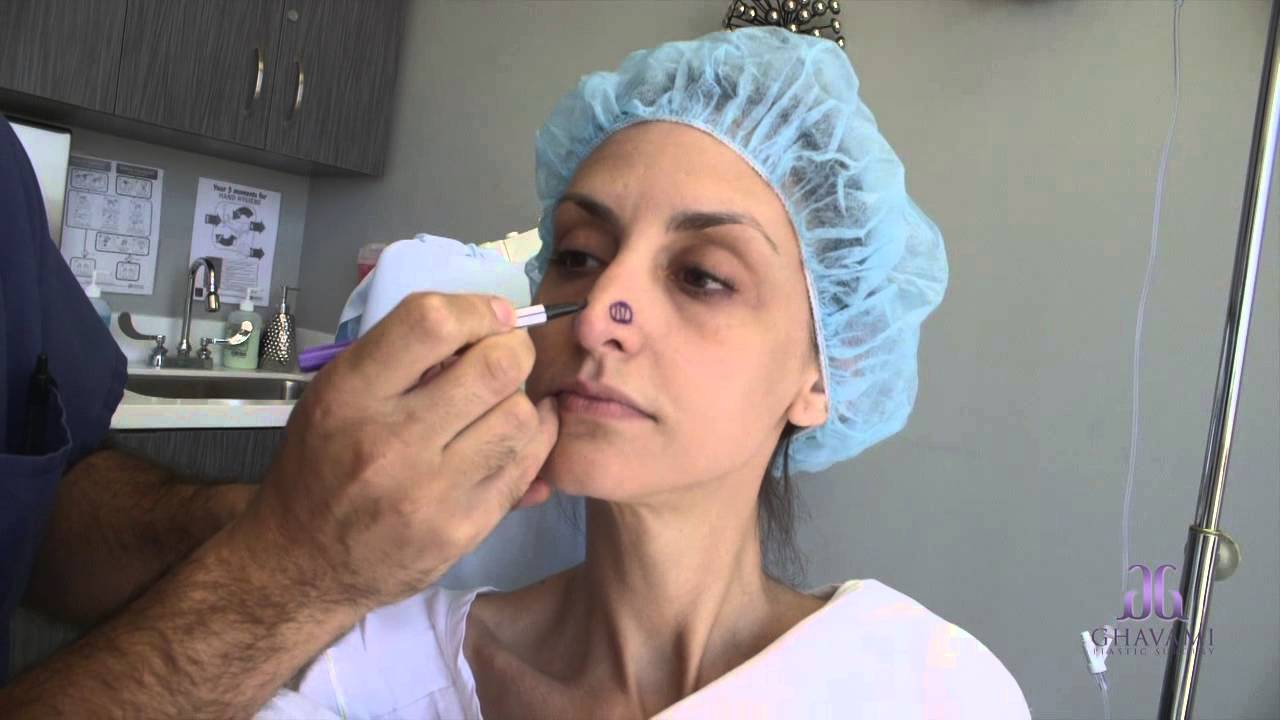 Gorgeous Revision Rhinoplasty Results by Dr. Ghavami - YouTube