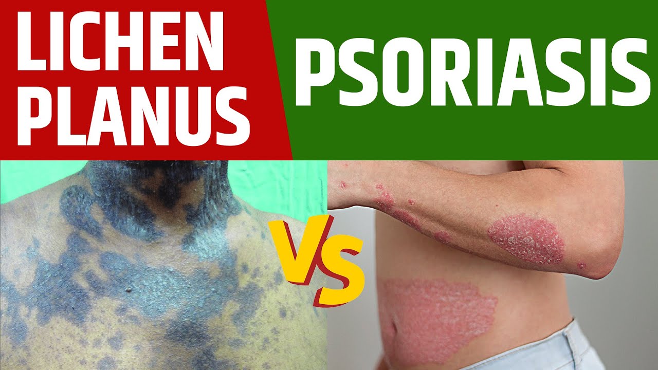 क्या है अंतर Lichen Planus और Psoriasis में ? | Lichen Planus VS ...
