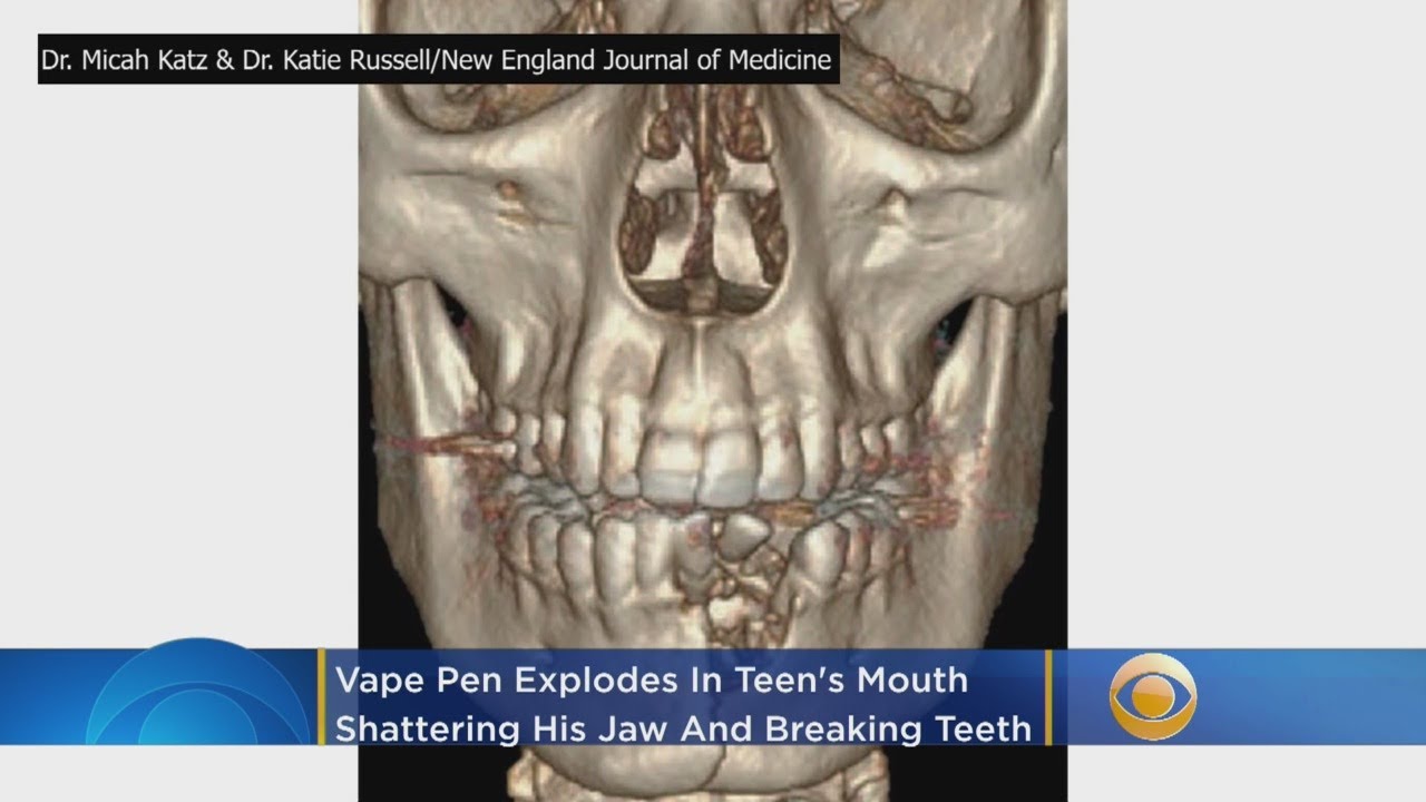 Vape Pen Explodes In Teen's Mouth, Shattering His Jaw - YouTube
