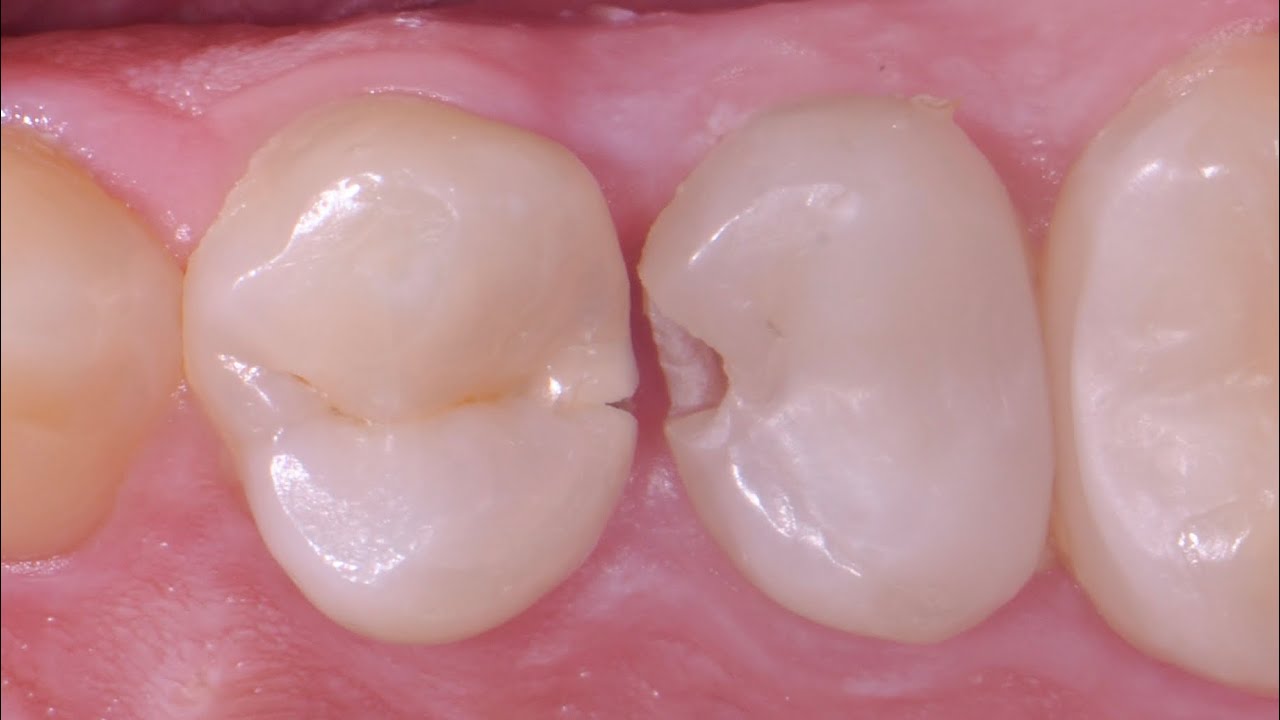 Bioclear injection overmolding back to back premolars MOD OD , DME ...